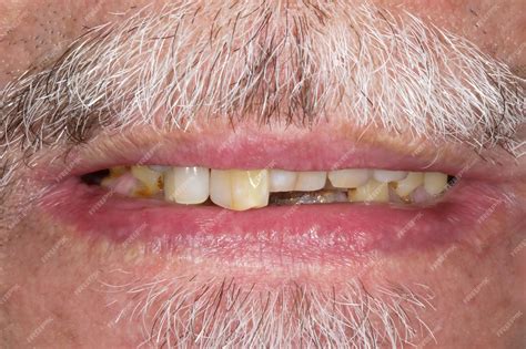 Premium Photo Chronic Generalized Paradontitis Severe Periodontal