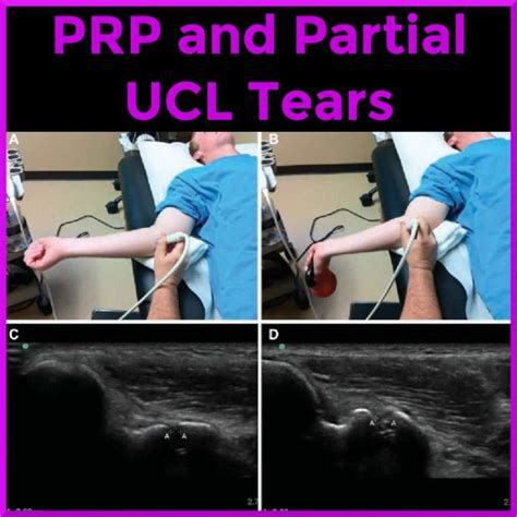 Prp For Partial Ucl Tears Sports Medicine Review