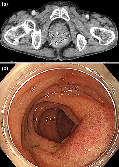 Rectal Metastasis From Lung Cancer Diagnosed By Endoscopic Ultrasound