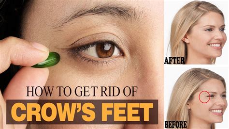 How To Get Rid Of Crows Feet Without Botox Home Remedies For Crows