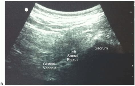 Ultrasound Guided Proximal Parasacral Block Anesthesia Key