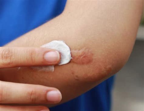 What Cancers Does 5 Fluorouracil Treat For Chemicalbook