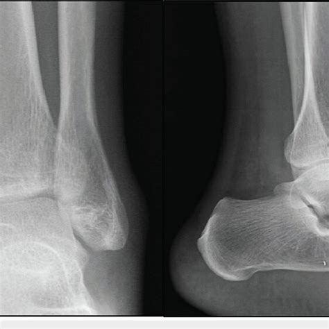 X Ray At Presentation Showing Minimally Displaced Tibial Plafond Fracture Download Scientific