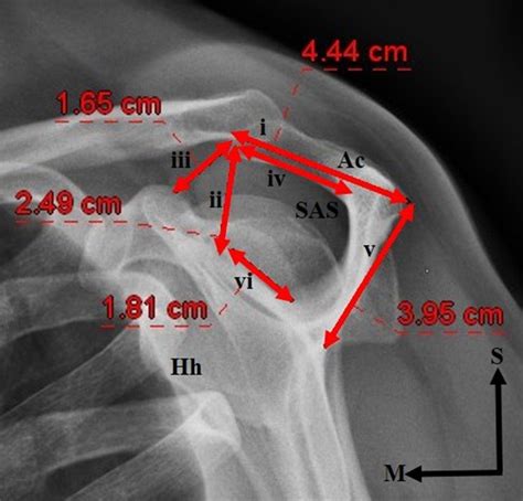 Morphometric Parameters Of The Subacromial Architecture I Acromial