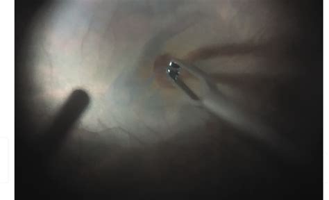 Ilm Flap Folded Over The Macular Hole Download Scientific Diagram