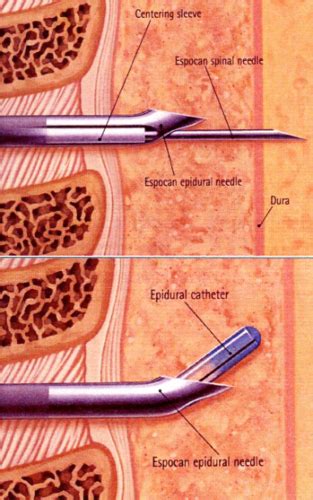 Combined Spinal Epidural Flashcards Quizlet