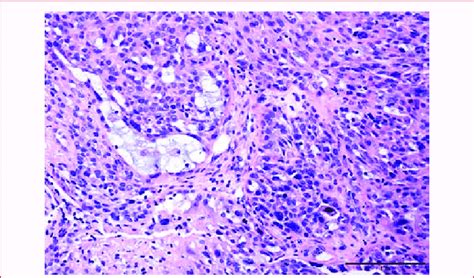High Grade Cytologic Atypia Occasional Sheets Of Spindle Neoplastic