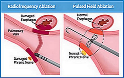 2020 AF Symposium Pulsed Field Ablation Vs RF Ablation A Study In