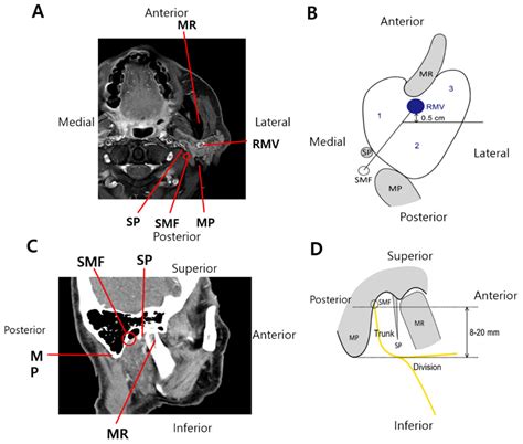 Retromandibular Vein Parotid