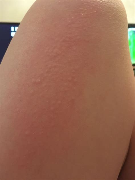 Best 13 Scabies Bites How To Identify Scabies Artofit