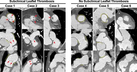 Subclinical Leaflet Thrombosis After Transcatheter Pulmonary Valve