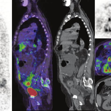 Areas Of Involvement Of Peritoneal Carcinomatosis Extent Download