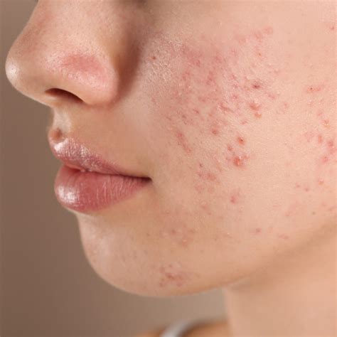 What Is Skin Purging And How Is It Different From A Breakout Experts Explain How To Understand