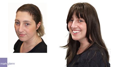 Female Hair Loss Before And After Hair Replacement Specialist Makeover