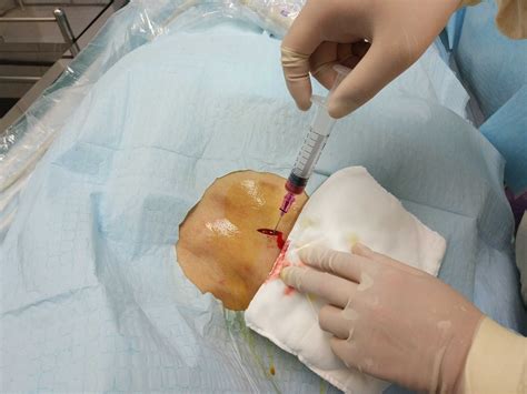 Is Venous Port Implantation Should Be Guided By X Ray ResearchGate