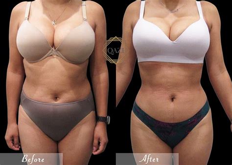 How To Do A Brazilian Butt Lift Safely Qazi Clinic Orange County CA