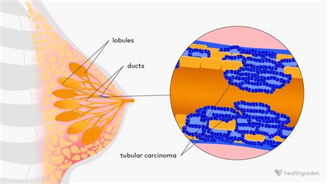 Tubular Carcinoma Breast Cancer Symptoms Treatments And Outlook