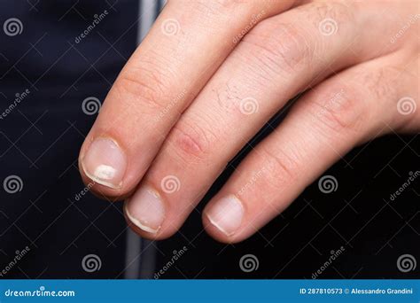 Fingernails Showing Signs Of Calcium Deficiency Stock Image Image Of