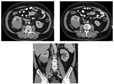 Ct Scan Showing The Right Renal Mass Download Scientific Diagram