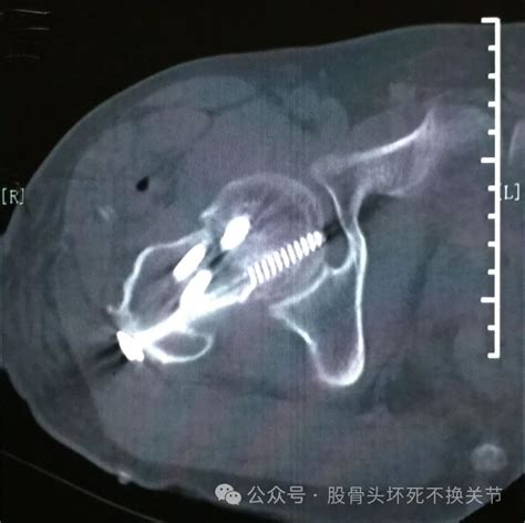 股骨颈骨折 “31”根钉，画蛇添足还是亡羊补牢？ 好医术文章 好医术 赋能医生守护生命