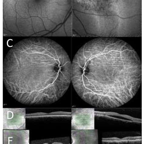 Multimodal Imaging Of Case 1 A Optos Imaging Showing Chorioretinal