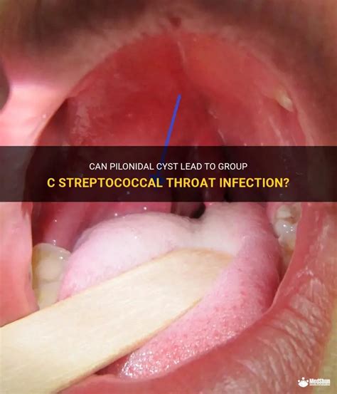 Can Pilonidal Cyst Lead To Group C Streptococcal Throat Infection Medshun