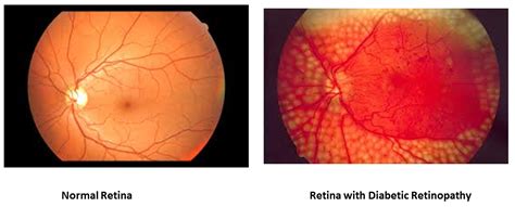 Normal Retina