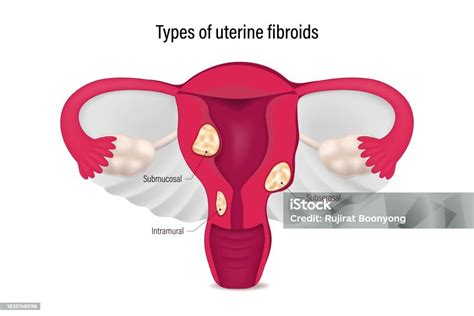Vetores De Tipos De Miomas Uterinos Miomas Submucosos Subserosos E