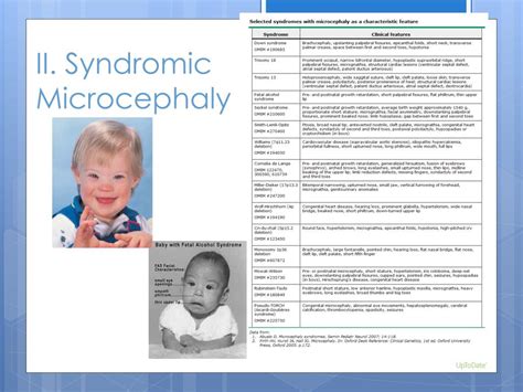 Ppt Microcephaly Powerpoint Presentation Free Download Id4497188