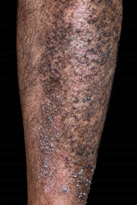 มีโรคผิวหนัง ชื่อ Lichen Amyloidosus หรือ Amyloidosis ซึ่งพบในคน