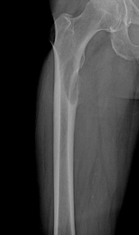Cookie Bite Skeletal Metastases Pacs