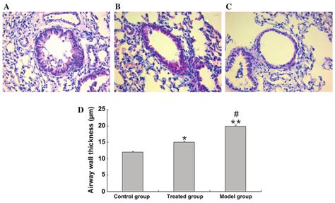 Bronchial Hyperplasia In Lung Tissue Was Observed Using Hematoxylin And