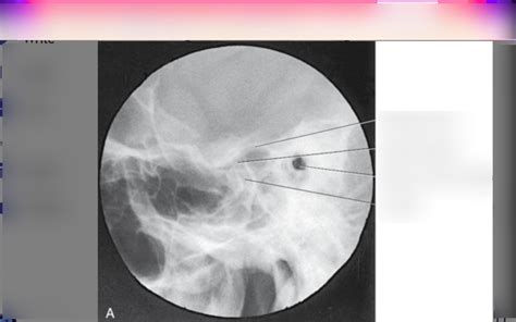 Tmj Axiolateral Oblique Diagram Quizlet