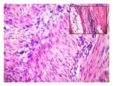 A Benign Mesenchymal Lesion Nodular Fasciitis Cytology Myxoid Download Scientific Diagram