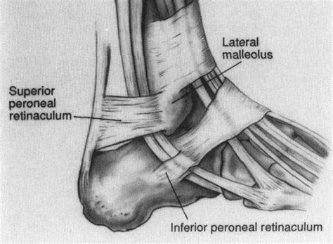 Peroneal Retinaculum Of The Foot Wikism Sports Medicine Wiki