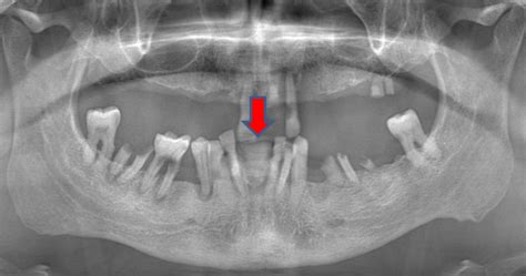 Red Arrow Shown Lesion Displaced Adjacent Teeth Download Scientific