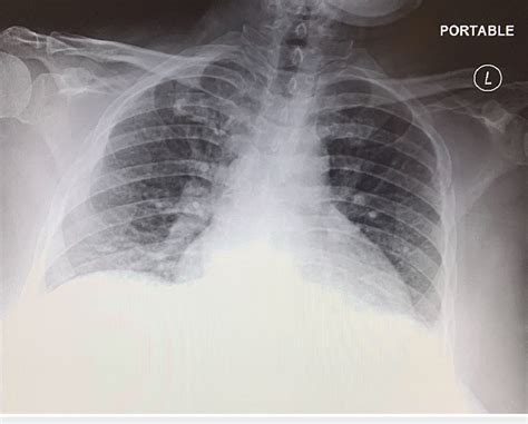 X Ray Demonstrating Decreased Lung Volumes With Central Bronchovascular