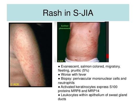 Systemic Jia The Clinical Picture