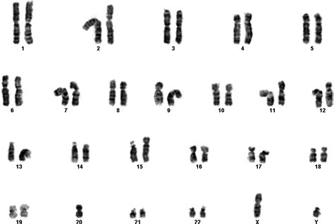 Robertsonian Translocation 13 14