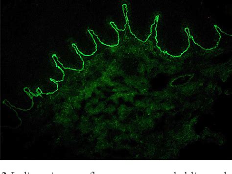 Figure 1 From Localized Bullous Pemphigoid A Case Report Semantic