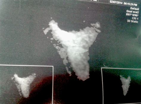 ECOGRAFIA 3D Il Ruolo Nella Ginecologia E Nei Percorsi Di PMA Dr