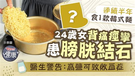 食用安全︱24歲女連續半年食1款韓式麵患膀胱結石 醫生警告：高鹽可致敗血症