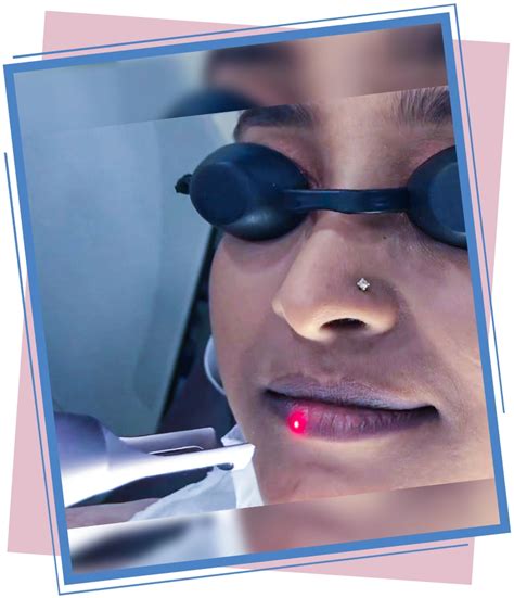 Q Switched Nd Yag Laser Dr Sajjas