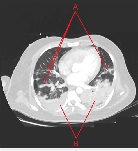 A Ct Pulmonary Angiography A Bilateral Patchy Consolidation Denoting Download Scientific
