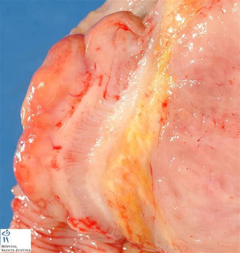 Colorectal Gist Human Pathology