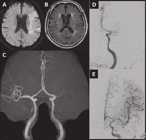 Diffusion Weighted Imaging DWI A Showing Several Hyperintense