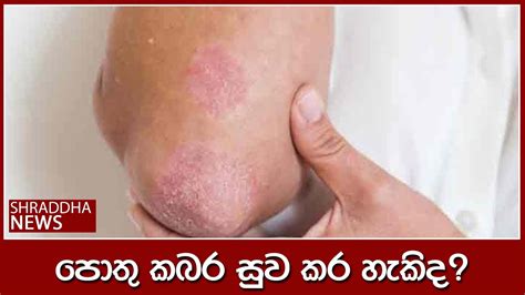 පොතු කබර සුව කර හැකිද Youtube