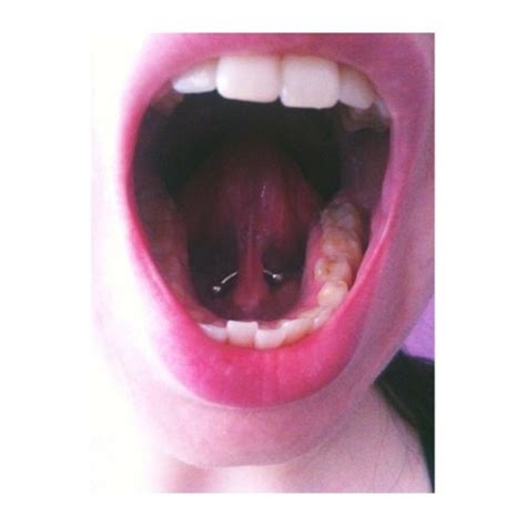 Tongue Frenulum On Tumblr