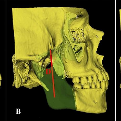 The Anterior Border Of The Infratemporal Fossa Can Be Visualized From A