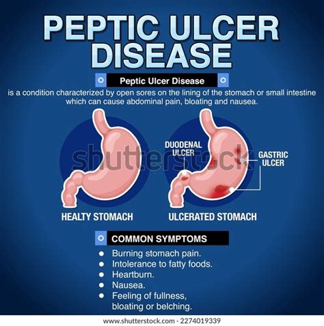 Peptic Ulcer Disease Explained Infographic Illustration Stock Vector